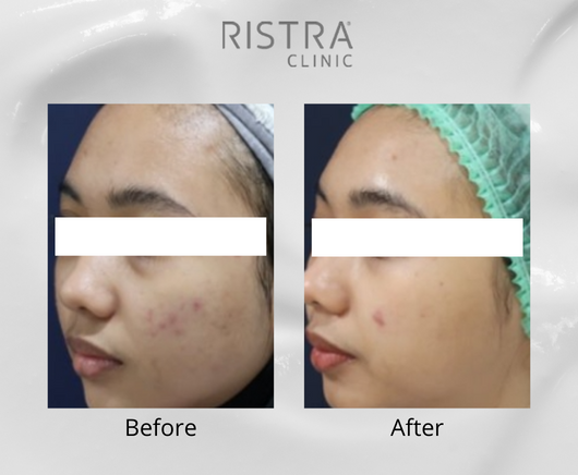 Jerawat & Komedo: Jenis, Cara Pencegahan & Treatment